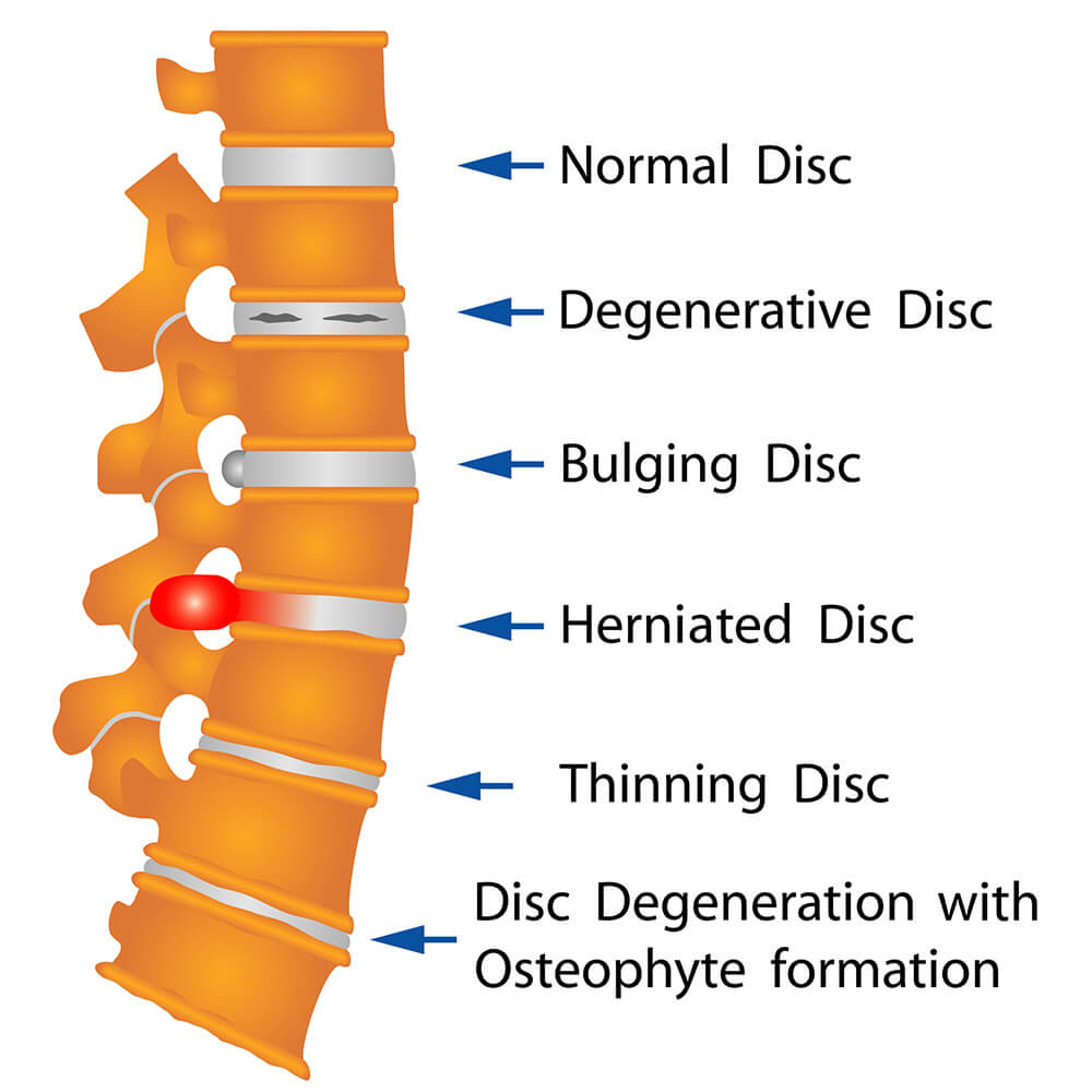 Disc Herniation Relief in Andersonville | Class IV Laser Therapy ...